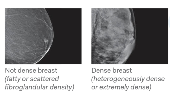 Breast Density - TRA Medical Imaging
