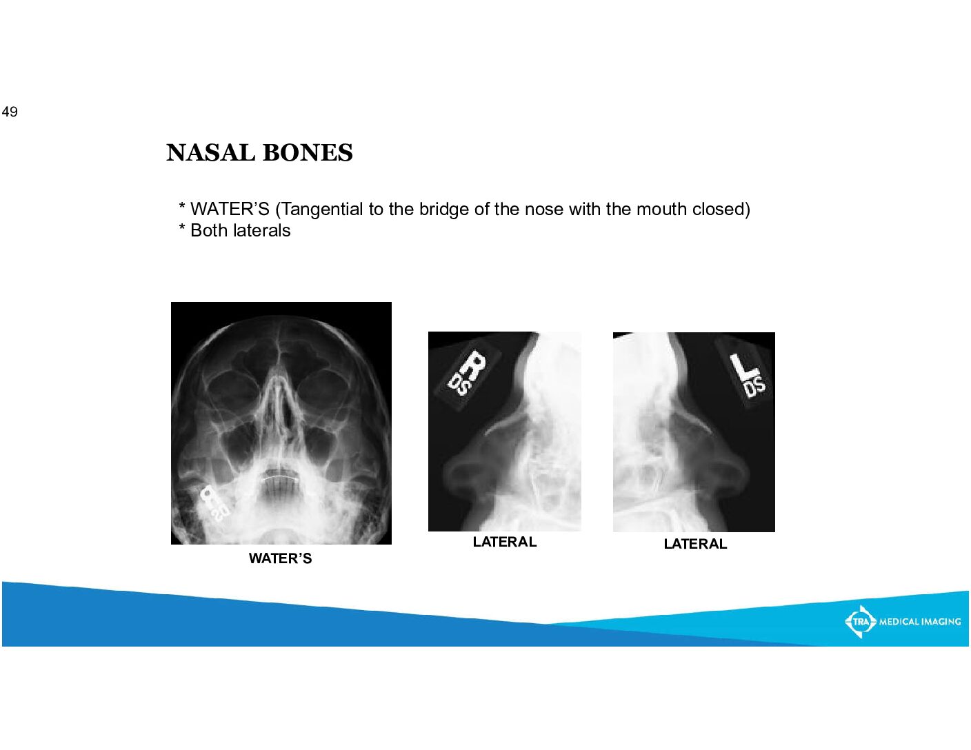 Nasal Bone Xray Midface Diagnosis Nasal/NOE, Nasal Bone AO