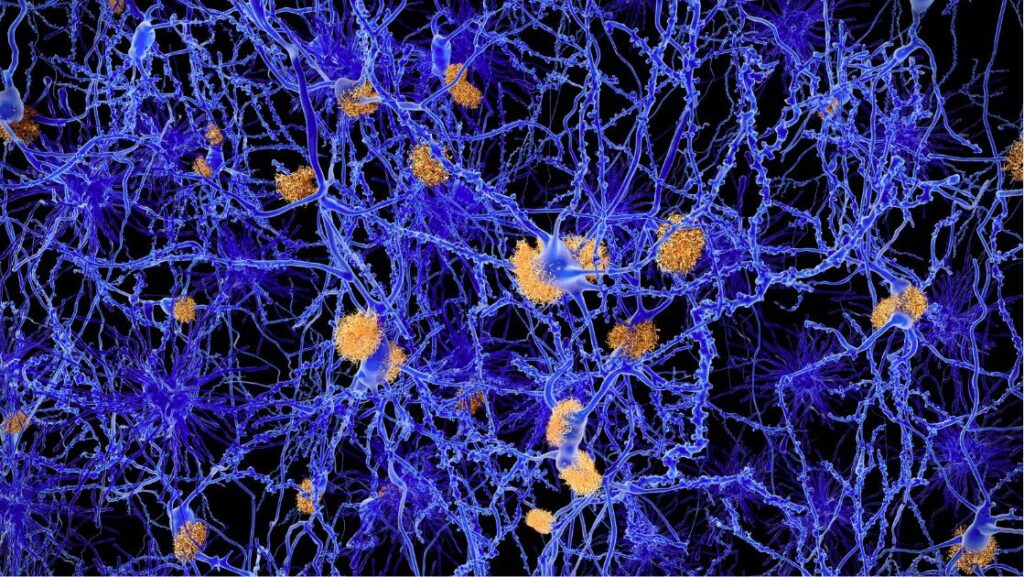 Understanding Amyloid PET/CT: A New Tool for Diagnosing Memory Loss ...